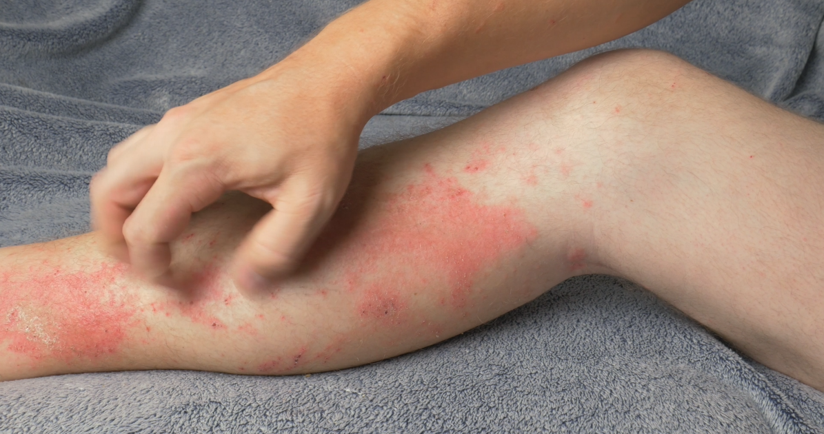 Debunking Myths and Misconceptions About Poison Ivy, Poison Oak, and ...