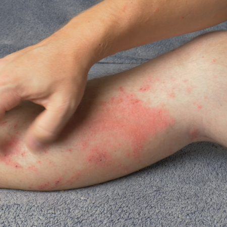 Across the Map: Uncovering the Geographical Distribution of Poison Ivy ...